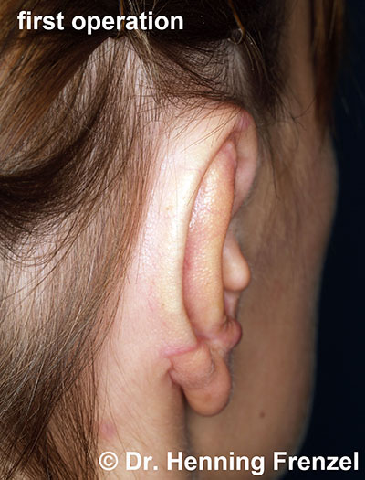Ohrrekonstruktion - Dr. med. Henning Frenzel | Mikrotie