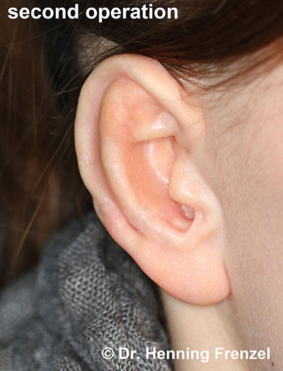 Ohrrekonstruktion - Dr. med. Henning Frenzel | Mikrotie