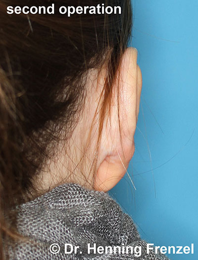 Ohrrekonstruktion - Dr. med. Henning Frenzel | Mikrotie