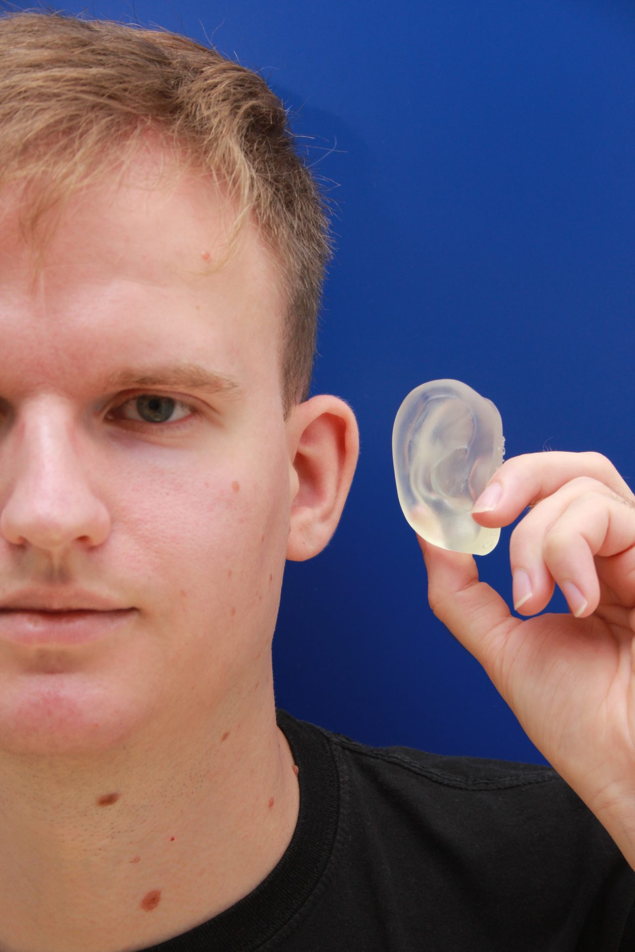 Ear Reconstruction - Microtia Germany | Dr. Henning Frenzel